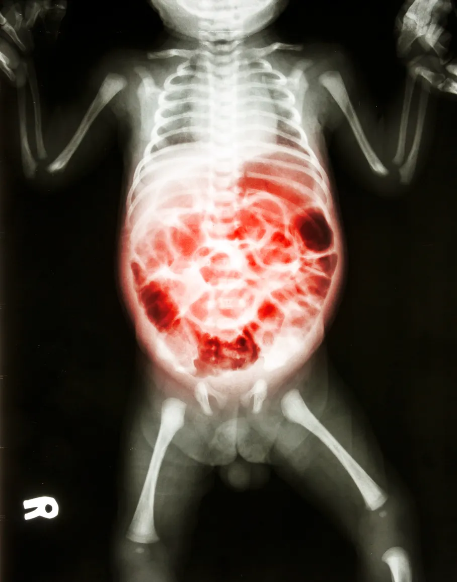 Necrotizing Enterocolitis X Ray